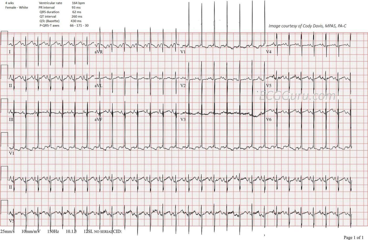 Pediatric ECG: One month old infant | ECG Guru - Instructor Resources